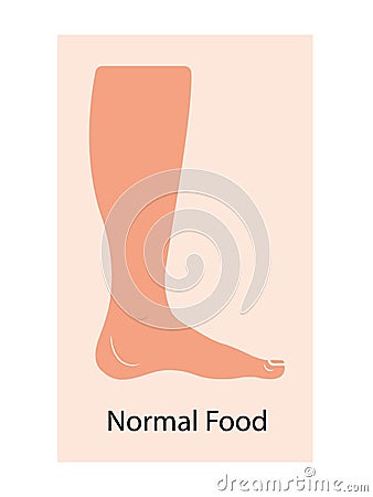 Lymphedema Stages. Royalty-Free Illustration | CartoonDealer.com #268808733