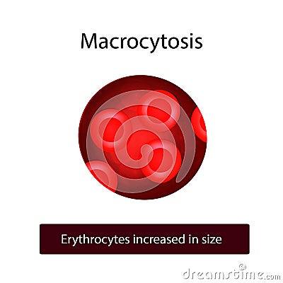 Macrocytes. Red Blood Cells Are Increased In Size. Vector Illustration ...