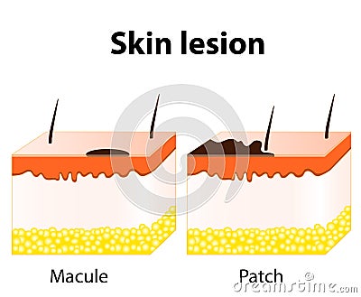 Macule And Patch. Types Of Skin Lesions Cartoon Vector | CartoonDealer ...