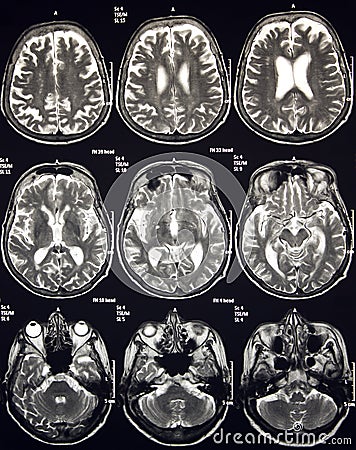 Magnetic Resonance Of Brain, MR Stock Image - Image: 9265521