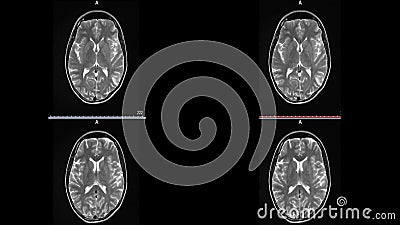 Magnetic Resonance Imaging of the Brain Sclerosis Microstroke White ...