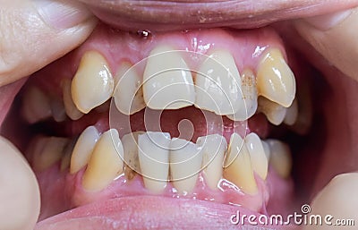 Malocclusion, Overcrowding Of Both Upper And Lower Teeth Stock Photo ...