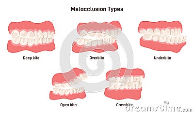 Malocclusion Types Set. Human Crooked Teeth. Misalignment Or Incorrect ...