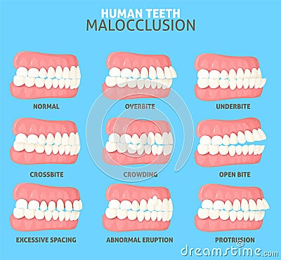 Malocclusion Types Side View Dentist Medical Poster Vector Illustration ...