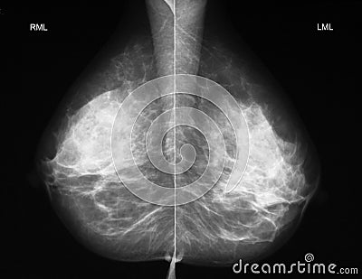 Mammography In Mediolateral Projection Stock Photo - Image: 10049710