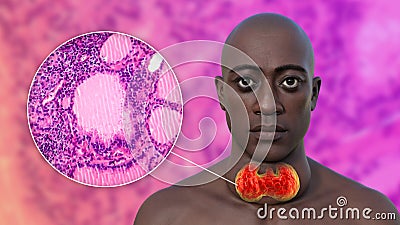 A Man With Enlarged Thyroid Gland, 3D Illustration, And Micrograph ...