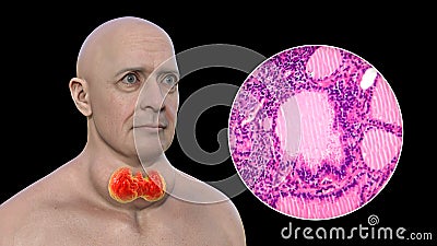 A Man With Enlarged Thyroid Gland, 3D Illustration, And Micrograph ...