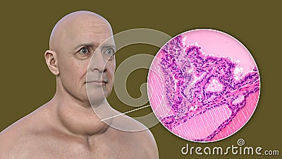 A Man With Enlarged Thyroid Gland, 3D Illustration, And Micrograph ...