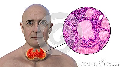 A Man With Enlarged Thyroid Gland, 3D Illustration, And Micrograph ...