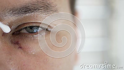 A Man Processes Stitches on a Wound after Surgery Stock Video - Video ...