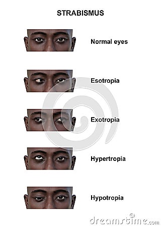 A Man With Various Strabismus Types, 3D Illustration | CartoonDealer ...