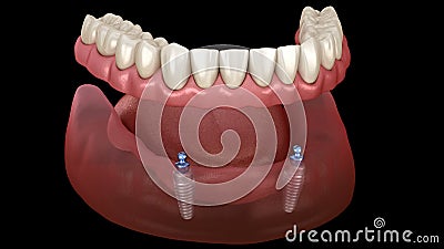 Mandibular Removable Prosthesis All on 2 System Supported by Implants ...