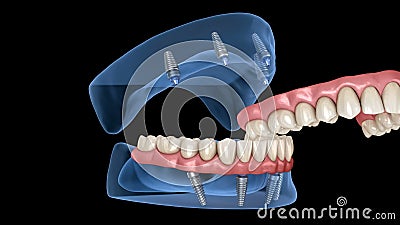 Maxillary Prosthesis All on 4 System Supported by Implants. Medically ...
