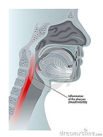 Pharyngitis Vector Illustration | CartoonDealer.com #29708128