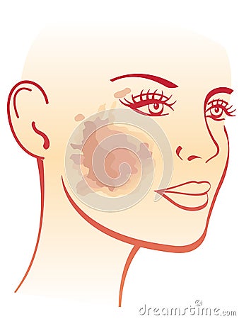 Melasma Illustration Cartoon Vector | CartoonDealer.com #98801415