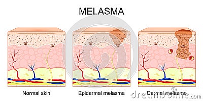 Melasma Types. Chloasma Faciei. Cross Section Of Human Skin With ...