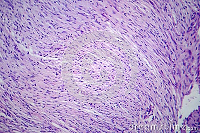Meningioma, Light Micrograph, Photo Under Microscope Royalty-Free Stock ...