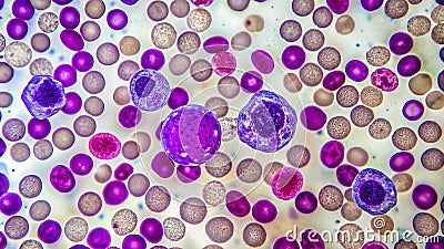 Microscope Slide Shows Irregular Lymphocytes A Potential Sign Of ...