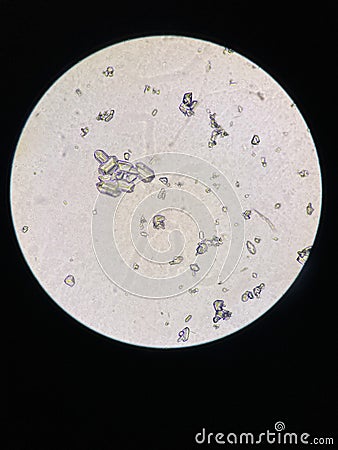 Microscopic View Of Struvite Crystals From Urinary Sediment. Magnesium ...