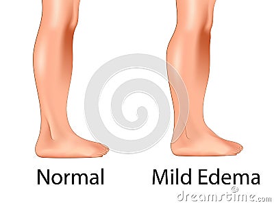 Mild Edema With Normal Leg Vector Illustration | CartoonDealer.com ...