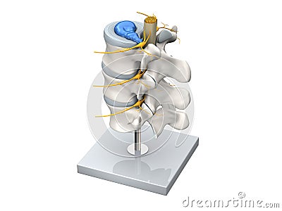 Model Of A Herniated Disc Of The Lumbar Spine. 3D Illustration Stock ...