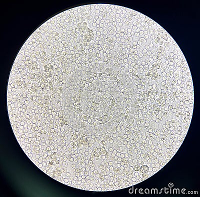 Moderate Bacteria And White Blood Cells In Urine Stock Image ...