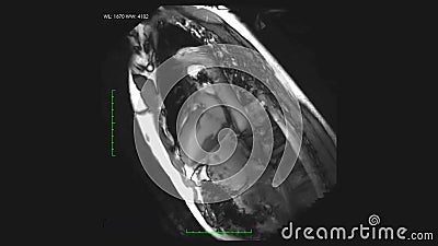 MRI Heart or Cardiac MRI of Heart in Vertical Long Axis View Showing ...
