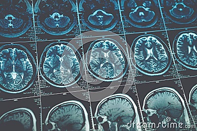 MRI or magnetic resonance image of head and brain scan. Close up view ...