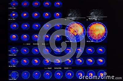 MRT Of The Heart And Coronary Vessels Stock Photo | CartoonDealer.com ...