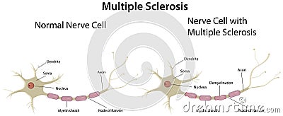 Multiple Sclerosis Diagram Stock Vector - Image: 39896855
