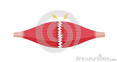 Muscle Rupture Vector Illustration ( Complete Tear | CartoonDealer.com ...