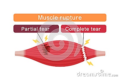 Muscle Rupture Vector Illustration (partial And Complete Tears ...