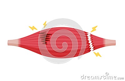 Muscle Rupture Vector Illustration (partial And Complete Tears ...