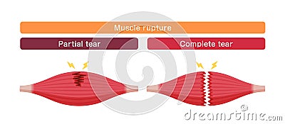 Muscle Rupture Vector Illustration (partial And Complete Tears ...