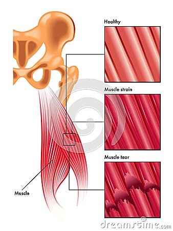 Muscle Strain And Tear Stock Photo - Image: 62932917