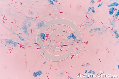 Mycobacterium Tuberculosis Stock Photo - Image: 80362283