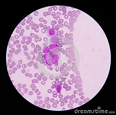 Myeloblasts Showing In Blood Smear. Stock Photo - Image: 67397983