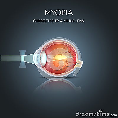 Myopia Corrected Cartoon Vector | CartoonDealer.com #52791027