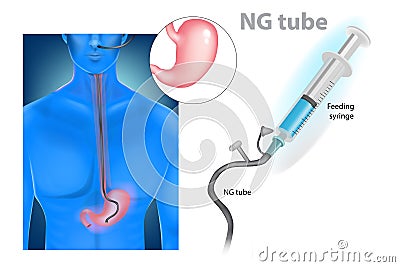 Nasogastric Tube Or NG Tube Cartoon Vector | CartoonDealer.com #145302721