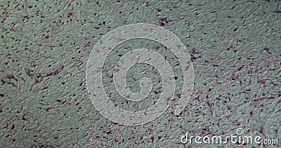 Necrosis of the Gallbladder in Cross Section Stock Video - Video of ...
