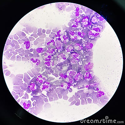 Neutrophil With Toxic Granulation And Vacuole Royalty-Free Stock Photo ...
