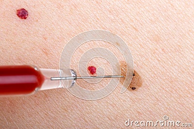Nevus And Cherry Angioma On Human Skin Royalty-Free Stock Image ...