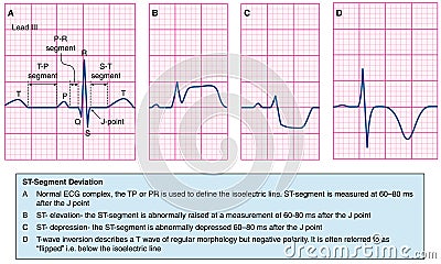 Normal And Abnormal Ecg Traces Cartoon Vector | CartoonDealer.com #59217571