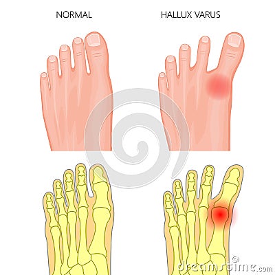 Normal Foot And Hallux Varus Vector Illustration | CartoonDealer.com ...