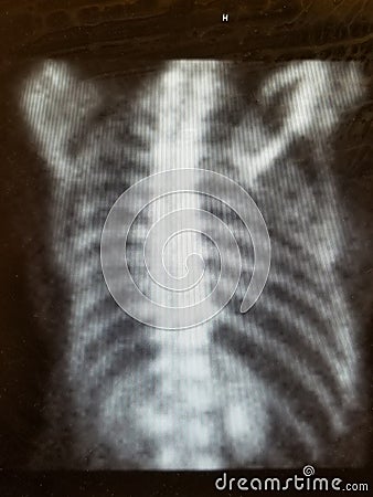 Indium Labeled WBC Scan - Normal Scan Images Royalty-Free Stock Photo ...