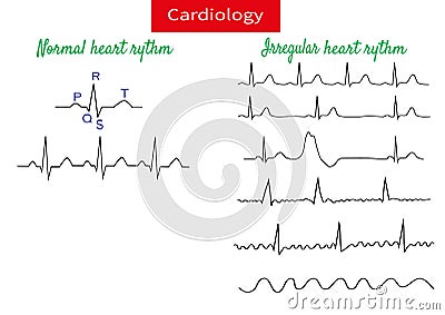 Normal And Pathological Ecg Collection. Royalty-Free Illustration ...