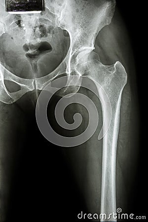 Normal Pelvis & Hip Joint Royalty-Free Stock Photography ...