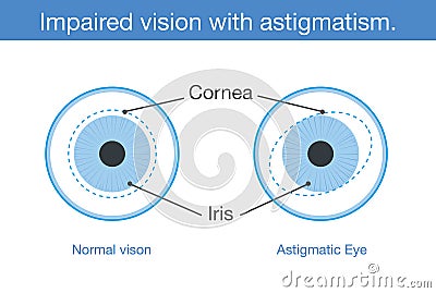 Normal Vision And Impaired Vision With Astigmatism In Front View ...