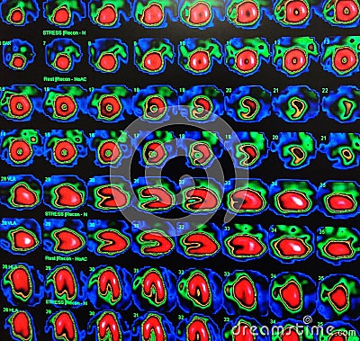 Nuclear Myocardial Perfusion Stress Test Stock Photo | CartoonDealer ...