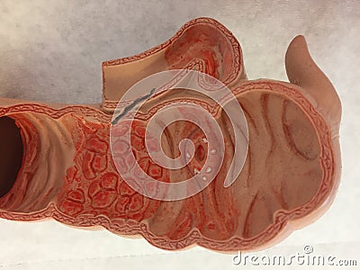 Old Anatomical Model Of Colon With Examples Of Different Diseases Stock ...